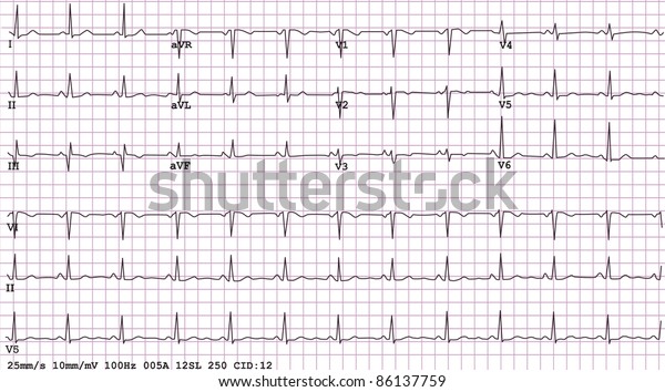 Example Normal 12lead Sinus Rhythm Electrocardiogram Stock Illustration ...