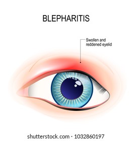 Eye Human Blepharitis Inflammation Reddening Eyelid Stock Illustration ...