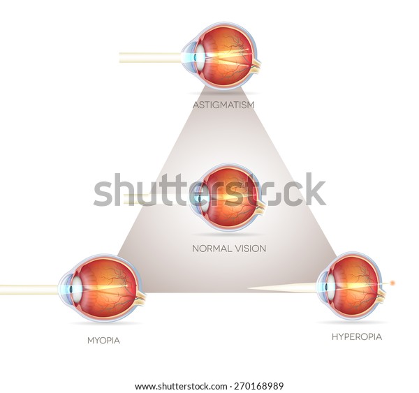Eye Vision Triangle Vision Disorders Normal Stock Illustration 270168989