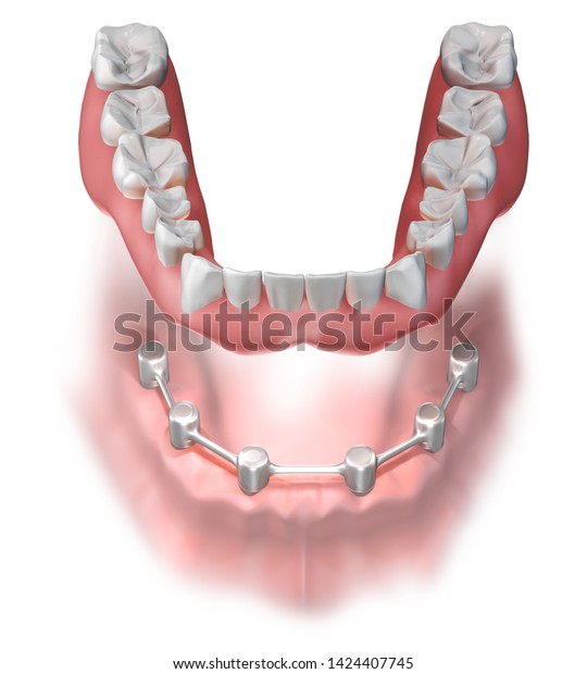 False Teeth Denture Putting On Lower Stock Illustration 1424407745 ...