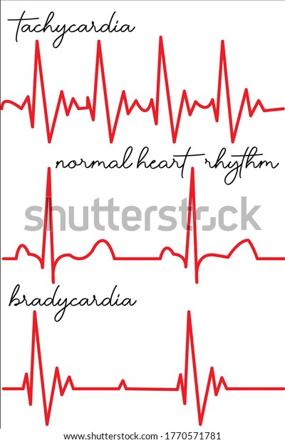 Flat Illustration Arrhythmia Stock Illustration 1770571781