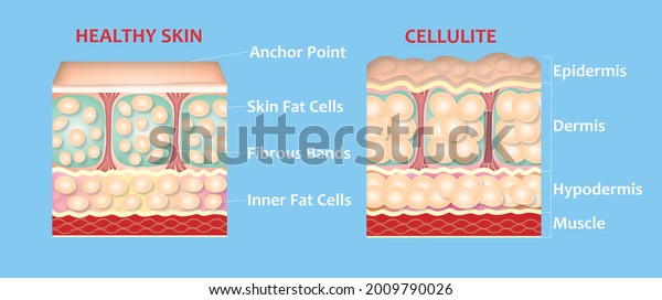 Forming Underskin Cellulite Illustration Structure Normal Stock ...