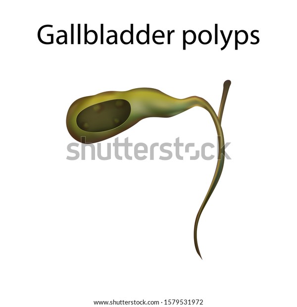 Gallbladder Polyps Abnormal Growth Tissue Medical Stock Illustration ...