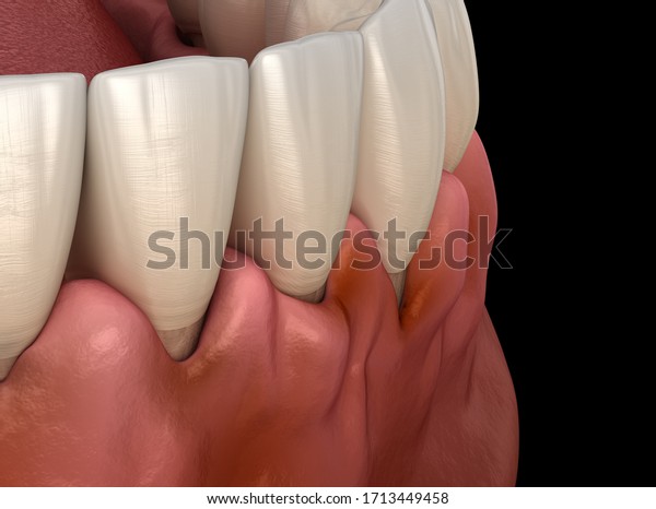 Gingivitis Inflammation Gums Medically Accurate 3d Stock Illustration ...