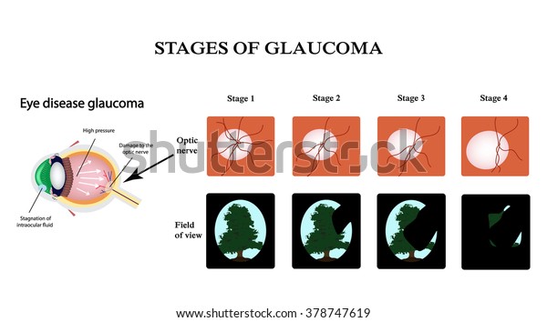 Glaucoma Structure Eye Field Vision Glaucoma Stock Illustration 378747619