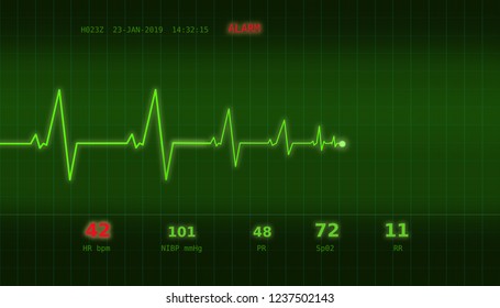 Graph Abnormal Heartbeat On Green Monitor Stock Illustration 1237502143 ...