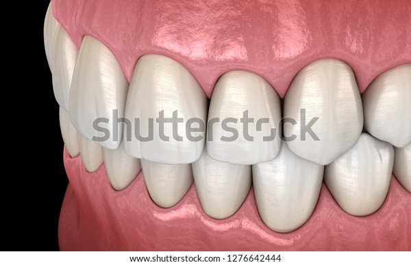 Healthy Human Teeth Normal Occlusion Side 스톡 일러스트 1276642444 | Shutterstock