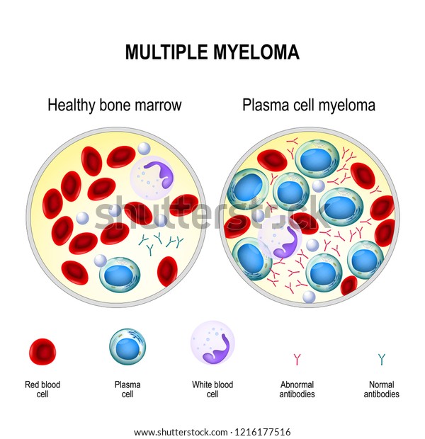 Healthy Plasma Cells Bone Marrow Mutate Stock Illustration 1216177516