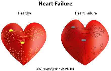 Heart Failure Stock Illustration 204033181