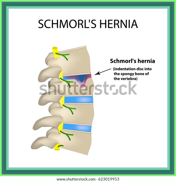 Hernia Schmorl Intervertebral Disc Side View: ilustrações stock ...