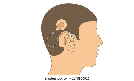 250 Cochlear implant Stock Illustrations, Images & Vectors | Shutterstock