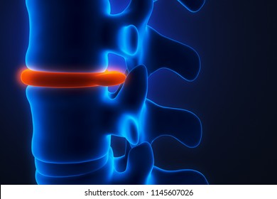 Human Spinal System Problem Concept Thinning Stock Illustration ...