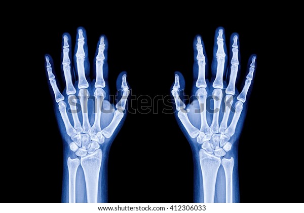 Xray Cartoon Hand