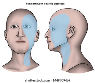 28 Carotid dissection Images, Stock Photos & Vectors | Shutterstock