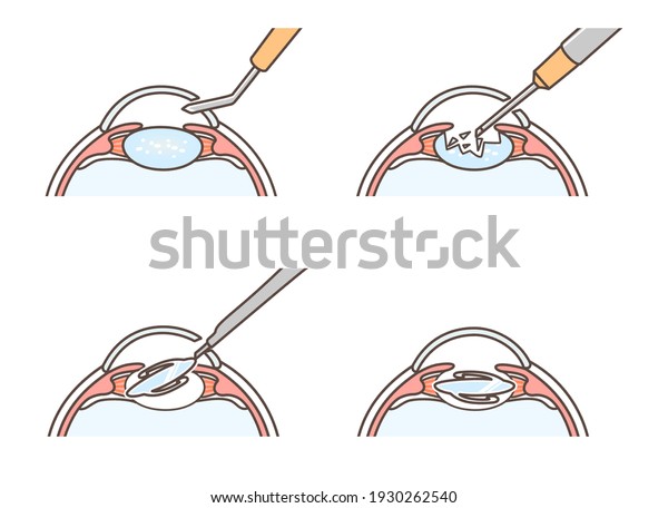 Illustrations Explaining Cataract Surgery Stock Illustration 1930262540 ...