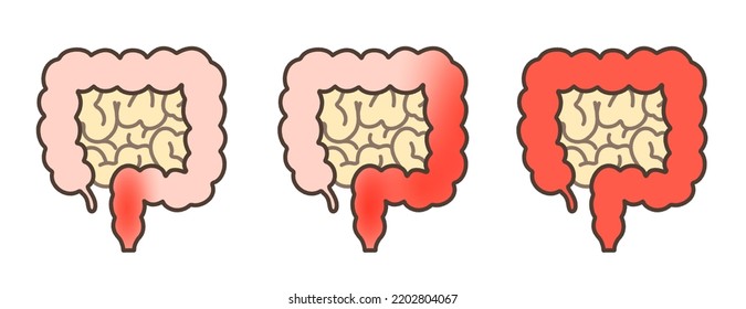 Illustrations Ulcerative Colitis Explain Stock Illustration 2202804067 ...