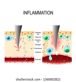 Inflammation Process By Which White Blood Stock Illustration 1360002821 ...
