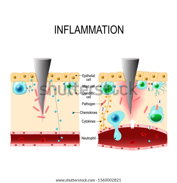 Inflammation Process By Which White Blood Stock Illustration 1360002821