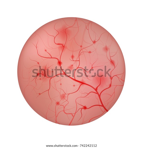 Inflammation Urinary Bladder Cystitis Interior Lining Stock ...