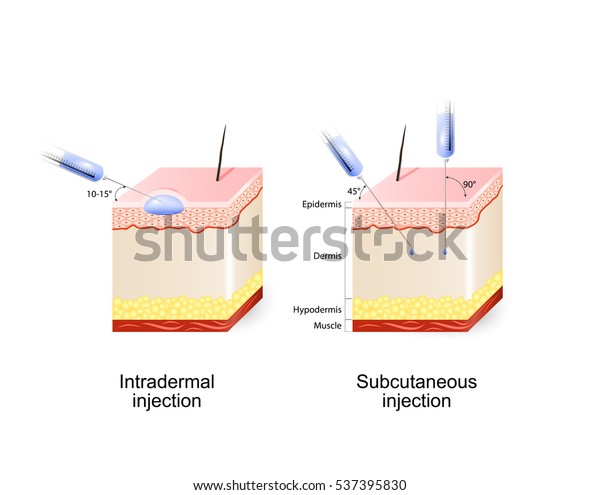 Intradermal Subcutaneous Injection Angle Depth Injections Stock ... Intradermal Subcutaneous Injection Angle Depth Injections Stock ...
