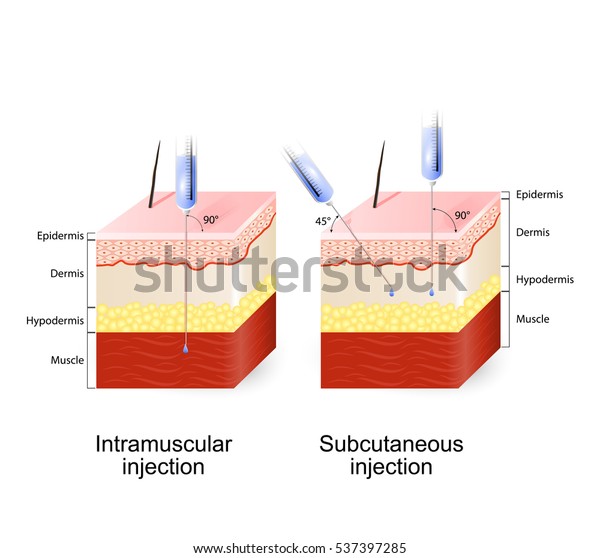 Intramuscular Injection Subcutaneous Injection Angle Depth 스톡 일러스트 ... Intramuscular Injection Subcutaneous Injection Angle Depth 스톡 일러스트 ...