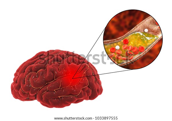 Ischemic Brain Stroke Concept 3d Illustration: ilustración de stock ...