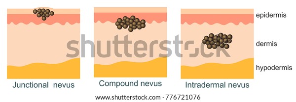 Junctionla Compound Intradermal Nevus Stock Illustration 776721076