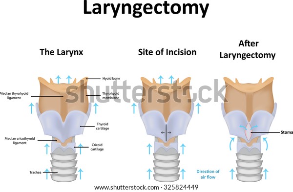 2 Total Laryngectomy Images, Stock Photos & Vectors | Shutterstock