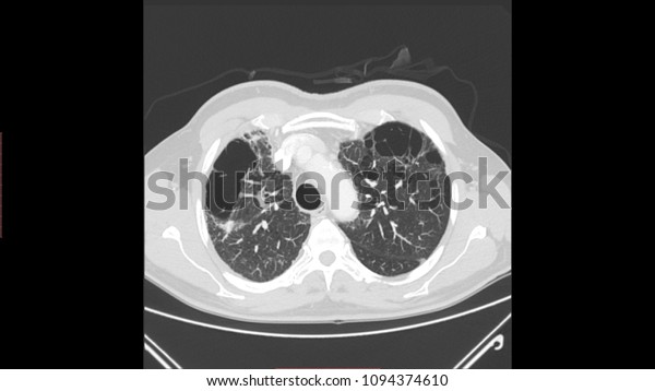 Lung Emphysema Ct Scan 스톡 일러스트 1094374610