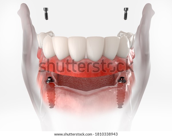 Mandibular fixed restoration with two implants. 3D illustration of ...