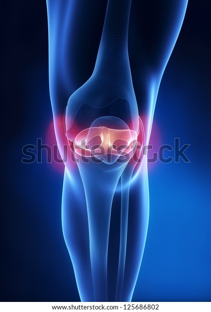 Meniscal Injuries Stock Illustration 125686802