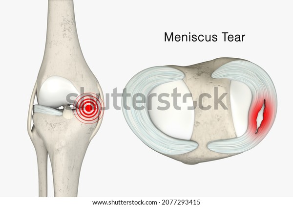 Meniscus Tear 3d Rendering Knee Anatomy Stock Illustration 2077293415 ...
