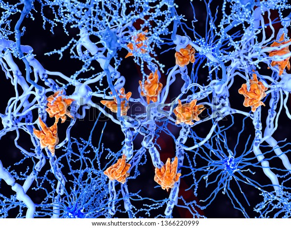 Multiple Sclerosis Ms Microglia Cells Orange Stock Illustration ...