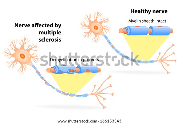 Nerve Affected By Multiple Sclerosis Stock Illustration 166153343