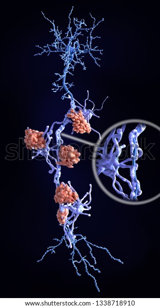 Neuron Affected By Multiple Sclerosis Microglia Stock Illustration ...