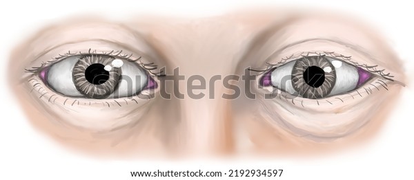 Normal Diameter Pupil Dilated Pupil Midbrain Stock Illustration ...