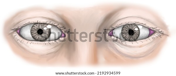 Normal Diameter Pupil Dilated Pupil Midbrain Stock Illustration ...