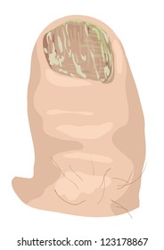 48 Dactylitis Toe Images, Stock Photos & Vectors | Shutterstock