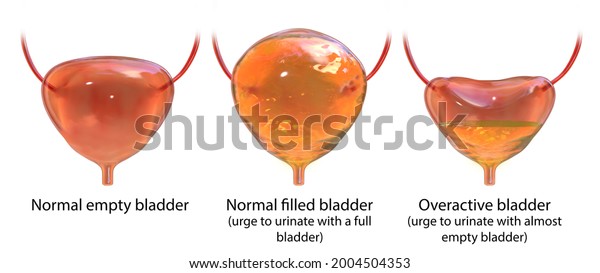 Overactive Bladder Urinary Bladder Empty Normal Stock Illustration ...