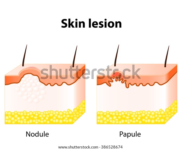 Papule Nodule Skin Lesion Stock Illustration 386528674