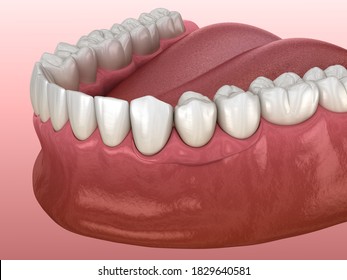 Removable Partial Denture Mandibular Prosthesis Medically Stock ...