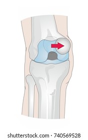Lattimore Dislocated Knee