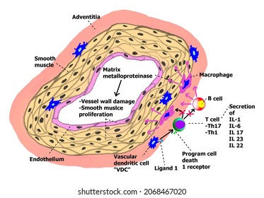 Pathogenesis Temporal Arteritis Giant Cell Arteritis Stock Illustration ...