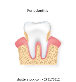 Periodontitis Stock Illustration 293175812 | Shutterstock