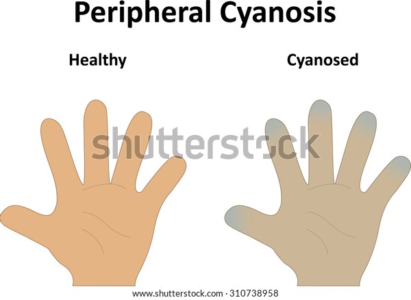 Peripheral Cyanosis Stock Illustration 310738958