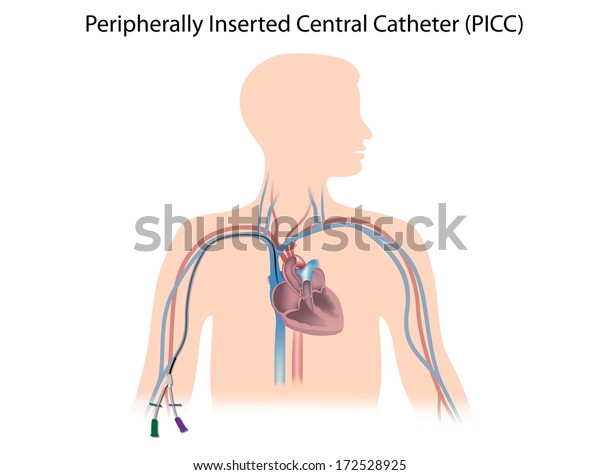Peripherally Inserted Central Catheter Stock Illustration 172528925