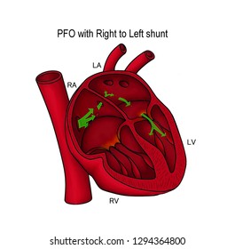 Pfo One Possible Cause Ischemic Stroke Stock Illustration 1294364800 ...