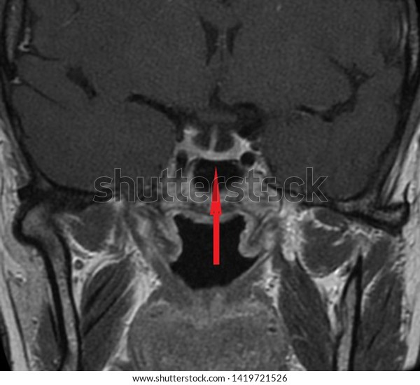 Pituitary Gland Hypophysis Mri Scan Magnetic: ilustrações stock ... Pituitary Gland Hypophysis Mri Scan Magnetic: ilustrações stock ...