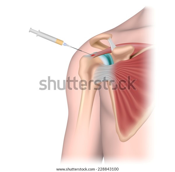 Platelet rich plasma (prp) treatment for rotator cuff injury Platelet rich plasma (prp) treatment for rotator cuff injury
