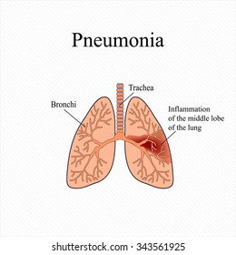 Pneumonia Anatomical Structure Human Lung Type: ภาพประกอบสต็อก ...